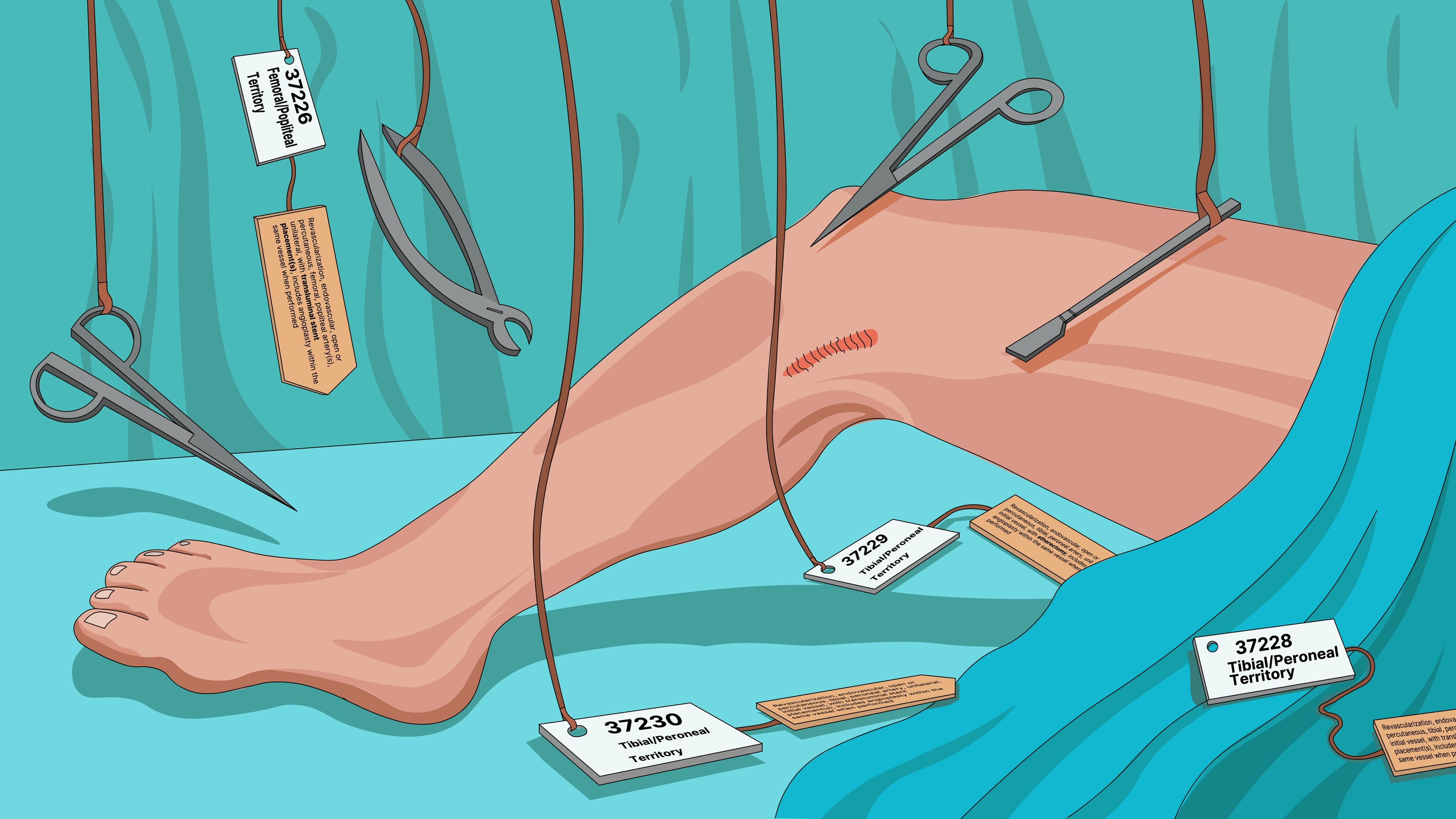 Coverself | A Comprehensive Guide to Coding Lower Extremity Endovascular Revascularization